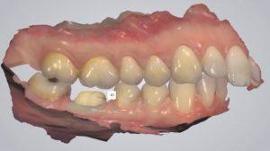 The 3D Digital Dental Record Using the Trios Intra-Oral Scanner | Boca ...